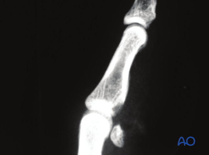Volar plate avulsion of the proximal end segment