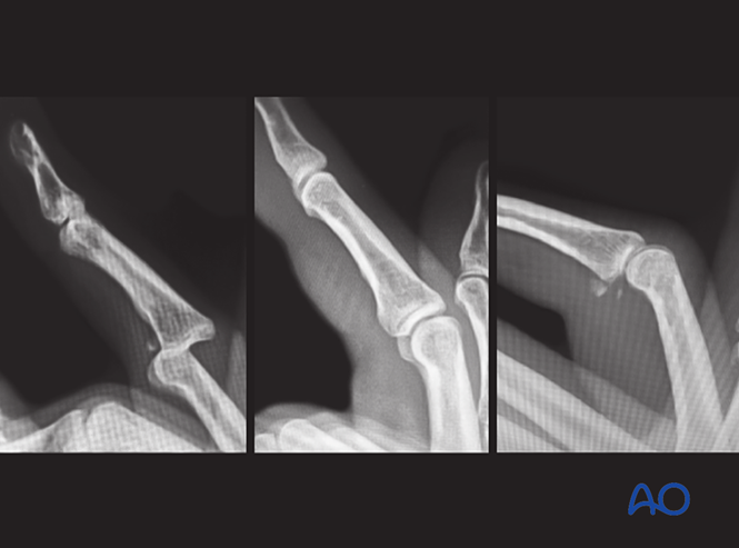 Volar plate avulsion of the proximal end segment