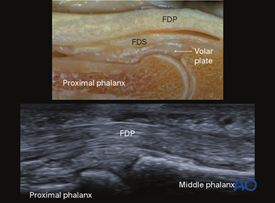Volar plate avulsion of the proximal end segment