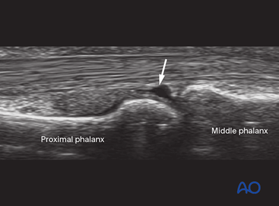 Volar plate avulsion of the proximal end segment