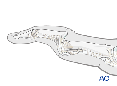 Dislocation of the proximal interphalangeal joint