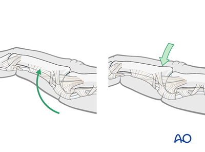 Collateral ligament repair for Dislocation of the proximal ...