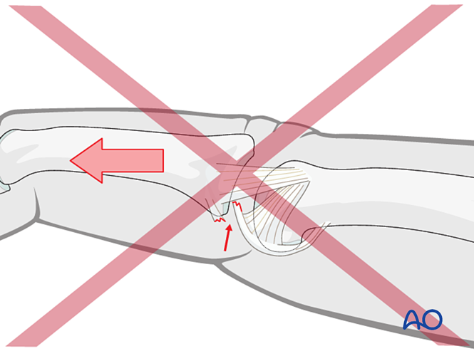 Nonoperative treatment for Dislocation of the proximal interphalangeal ...