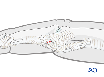 Nonoperative treatment for Volar plate avulsion of the proximal end segment