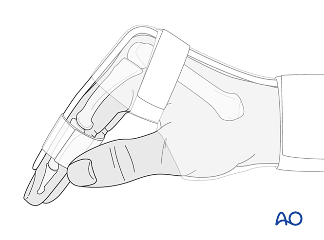 Extensor block pinning with joint transfixation for Dorsal avulsion of ...