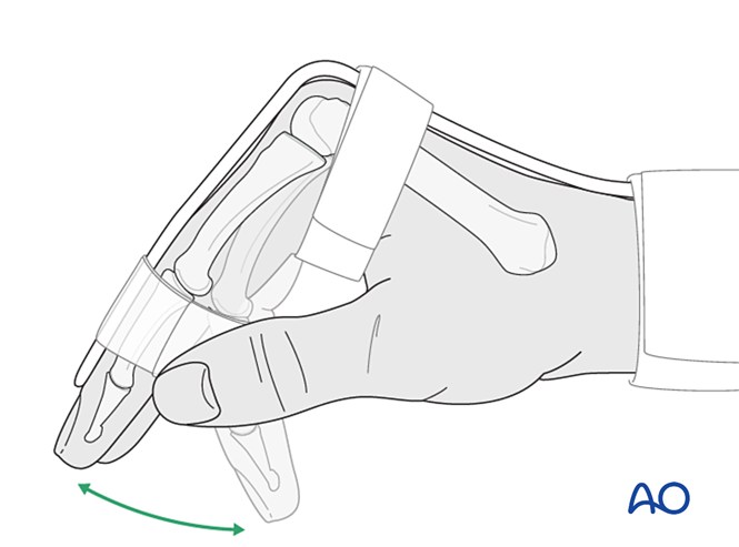 Nonoperative treatment for Dislocation of the proximal interphalangeal ...