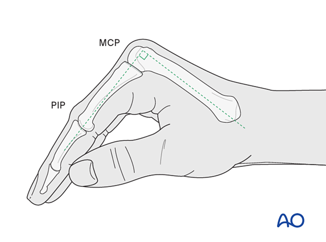 Nonoperative treatment for Volar plate avulsion of the proximal end segment