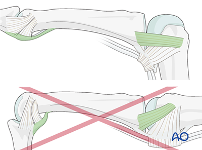 Nonoperative treatment for Dislocation of the proximal interphalangeal ...