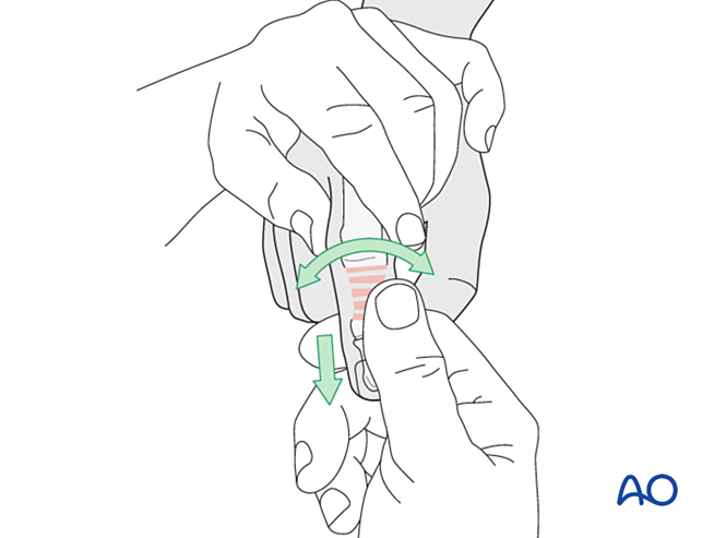 Nonoperative treatment for Multifragmentary extraarticular or ...