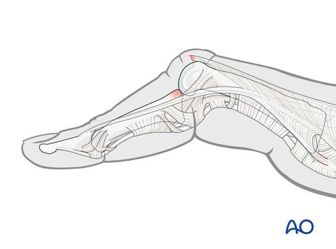 Nonoperative treatment for Dorsal avulsion of the proximal end segment