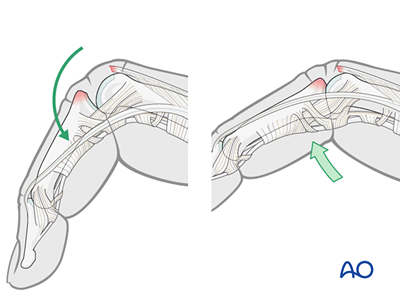 Nonoperative treatment for Dorsal avulsion of the proximal end segment