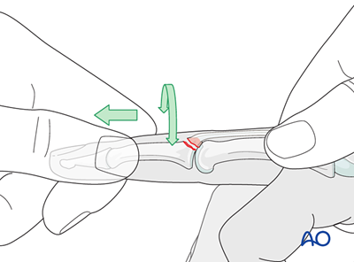 Nonoperative treatment for Dorsal avulsion of the proximal end segment