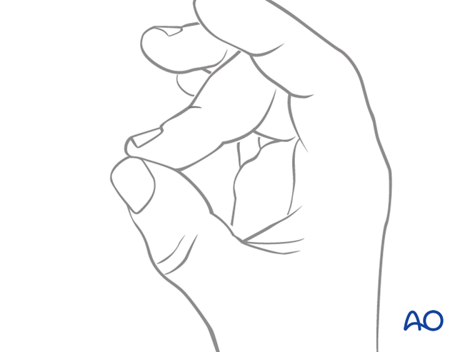 Central slip reattachment for Dorsal avulsion of the proximal end segment
