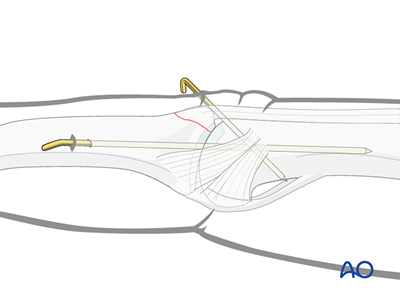Extensor block pinning with joint transfixation for Dorsal avulsion of ...