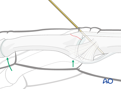 Extensor block pinning with joint transfixation for Dorsal avulsion of ...