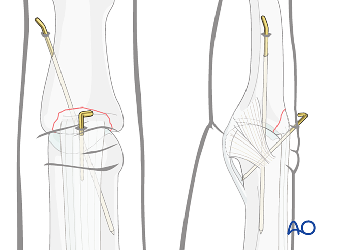 Extensor block pinning with joint transfixation for Dorsal avulsion of ...