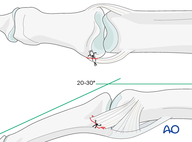 Collateral ligament repair for Dislocation of the proximal ...