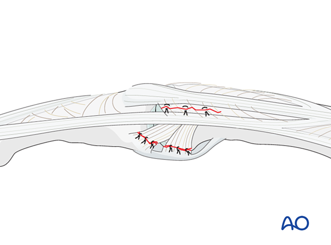 Volar plate reattachment for Volar plate avulsion of the proximal end ...