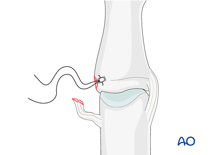 Collateral ligament repair for Dislocation of the proximal ...