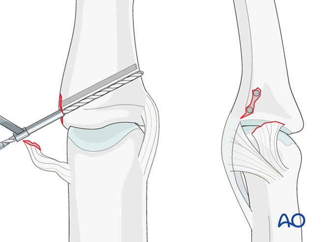 Collateral ligament repair for Dislocation of the proximal ...