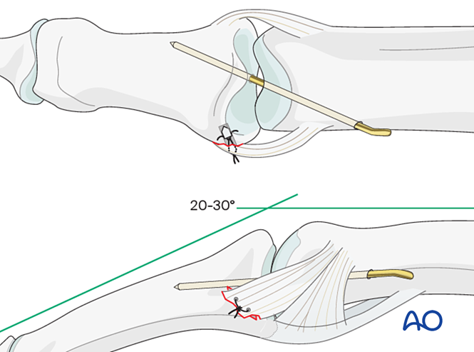 Collateral ligament repair for Dislocation of the proximal ...