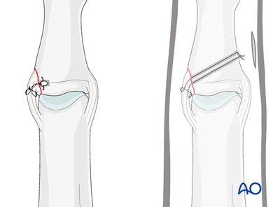 Collateral ligament reattachment for Collateral ligament avulsion of ...