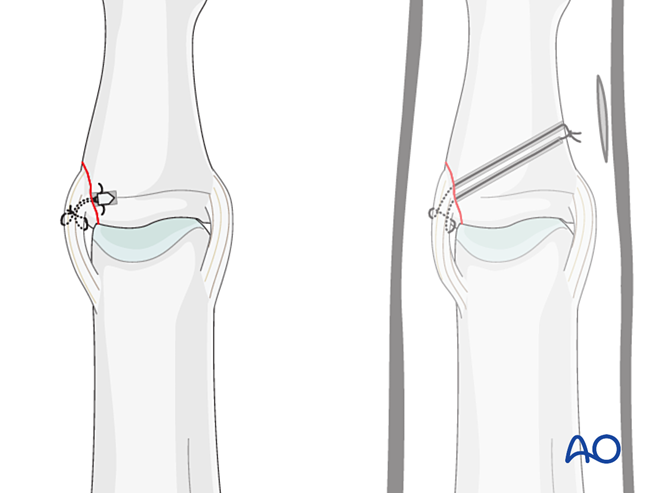 Collateral ligament reattachment for Collateral ligament avulsion of ...