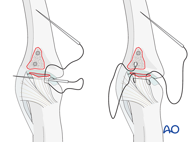 Collateral ligament reattachment for Collateral ligament avulsion of ...