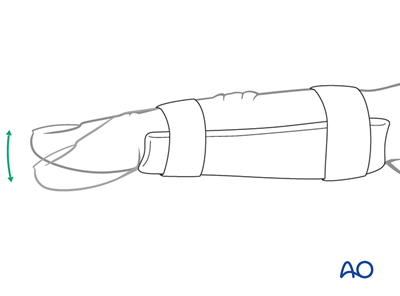 Extensor block pinning with joint transfixation for Dorsal avulsion of ...