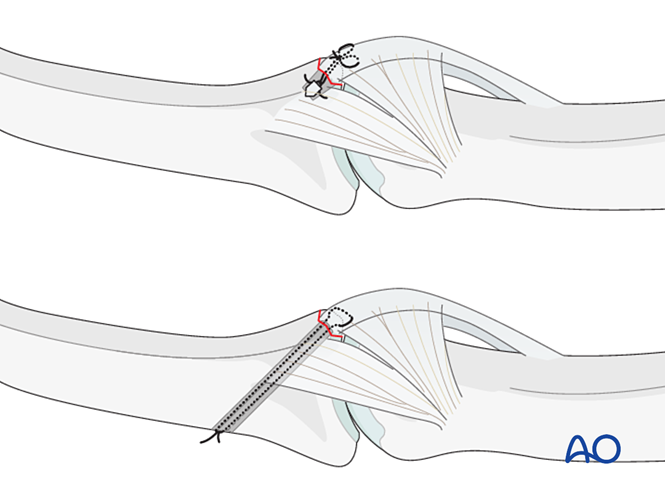 Volar plate reattachment for Volar plate avulsion of the proximal end ...