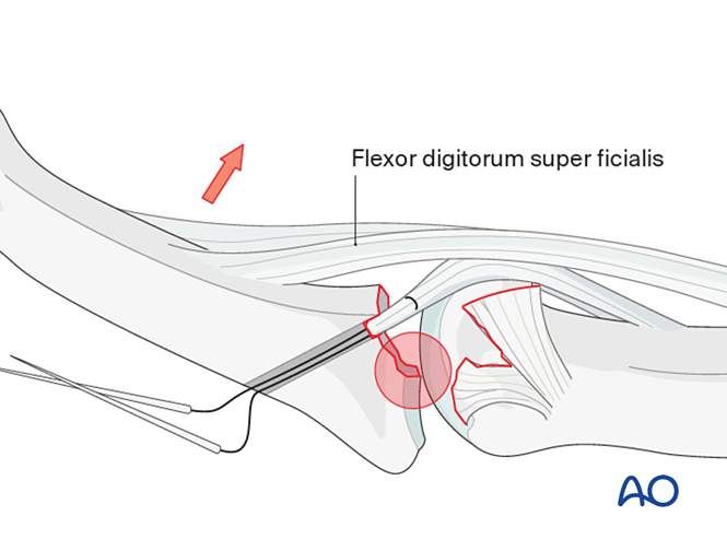 Volar plate arthroplasty for Multifragmentary articular fracture of the ...