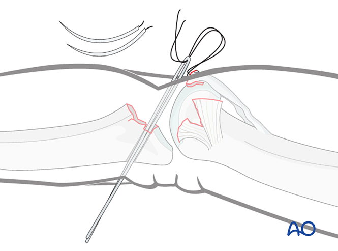 Volar plate arthroplasty for Multifragmentary articular fracture of the ...
