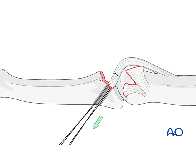 Volar plate arthroplasty for Multifragmentary articular fracture of the ...