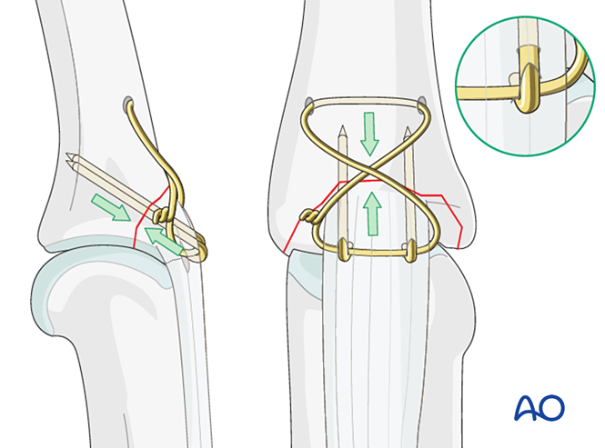 Cerclage compression wiring for Dorsal avulsion of the proximal end segment