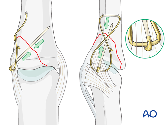 Cerclage compression wiring for Collateral ligament avulsion of the ...