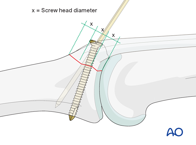 Lag-screw fixation for Dorsal avulsion of the proximal end segment