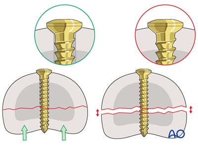 Lag-screw fixation for Dorsal avulsion of the proximal end segment