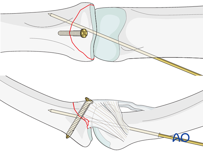 Lag-screw fixation for Volar plate avulsion of the proximal end segment