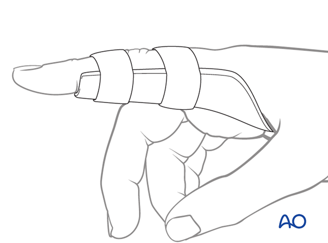 Volar plate reattachment for Volar plate avulsion of the proximal end ...