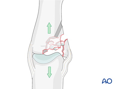 Joint reconstruction of lateral plateau fracture for Multifragmentary ...