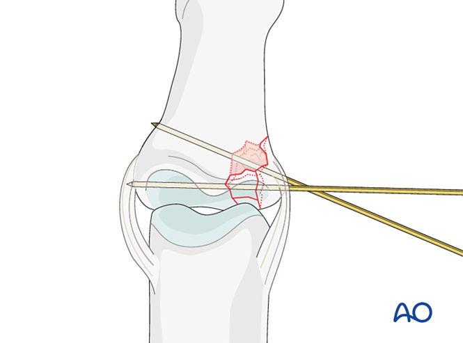 Joint reconstruction of lateral plateau fracture for Multifragmentary ...