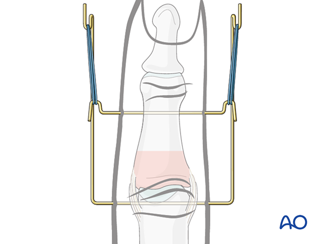 Joint reconstruction of central impaction fracture for Multifragmentary ...