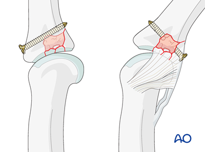 Joint reconstruction of central impaction fracture for Multifragmentary ...