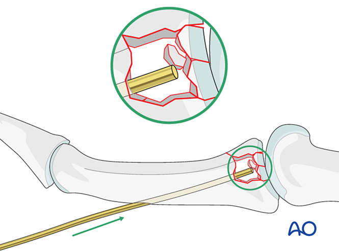 Dynamic external fixation for Multifragmentary articular fracture of ...