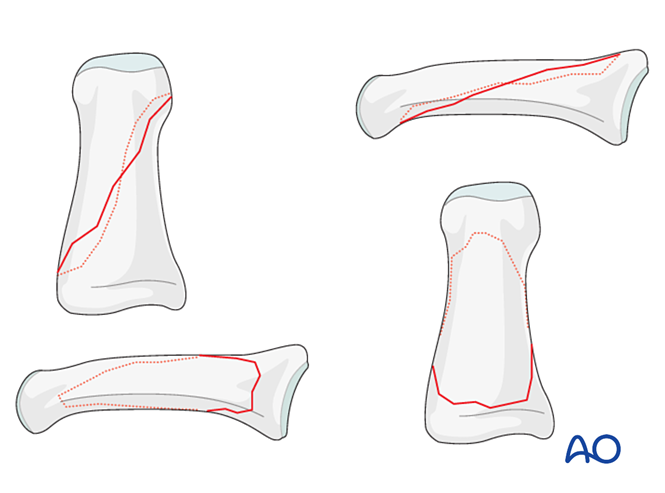 Lag-screw fixation for Oblique extraarticular or diaphyseal fracture