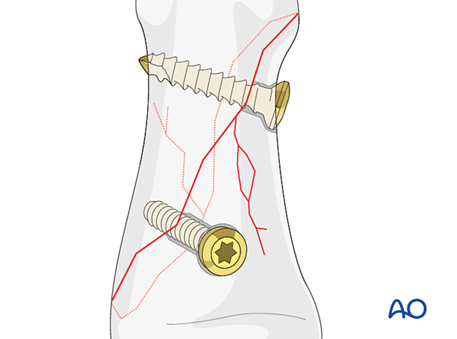 Lag-screw and plate fixation for Multifragmentary extraarticular or ...