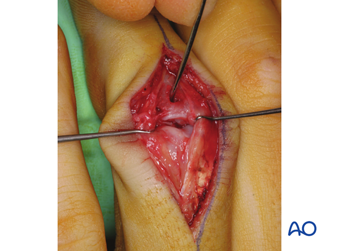 Joint reconstruction of palmar impaction fracture for Multifragmentary ...