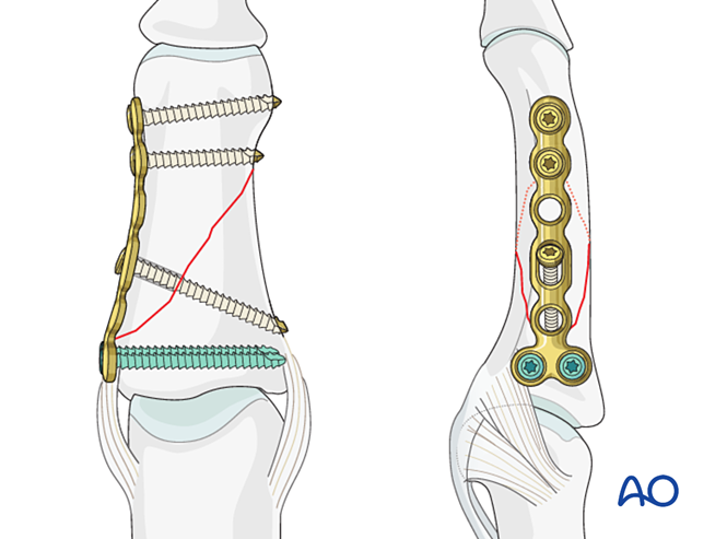 Compression plating for Oblique extraarticular or diaphyseal fracture