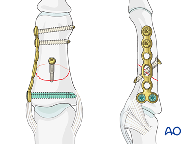 Compression plating for Oblique extraarticular or diaphyseal fracture
