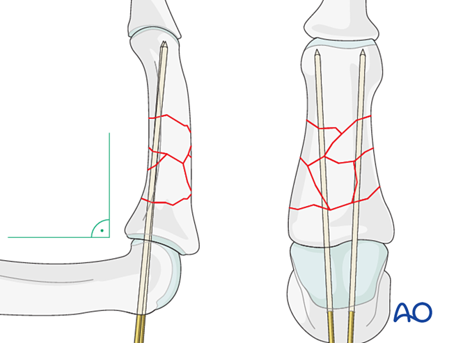 Bridge plating for Multifragmentary extraarticular or diaphyseal fracture